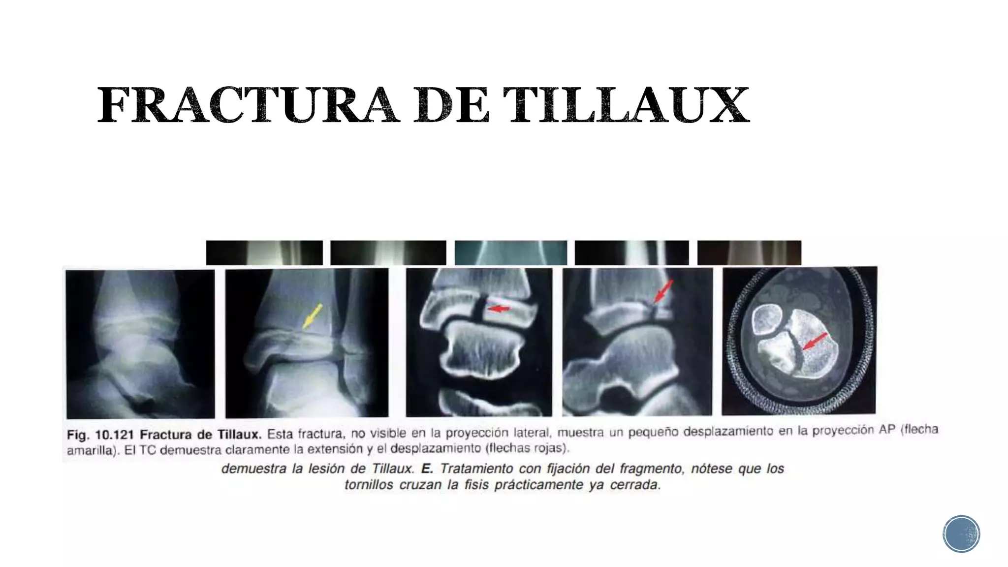 Fracturas de tibia y tobillo en niños | PPTX