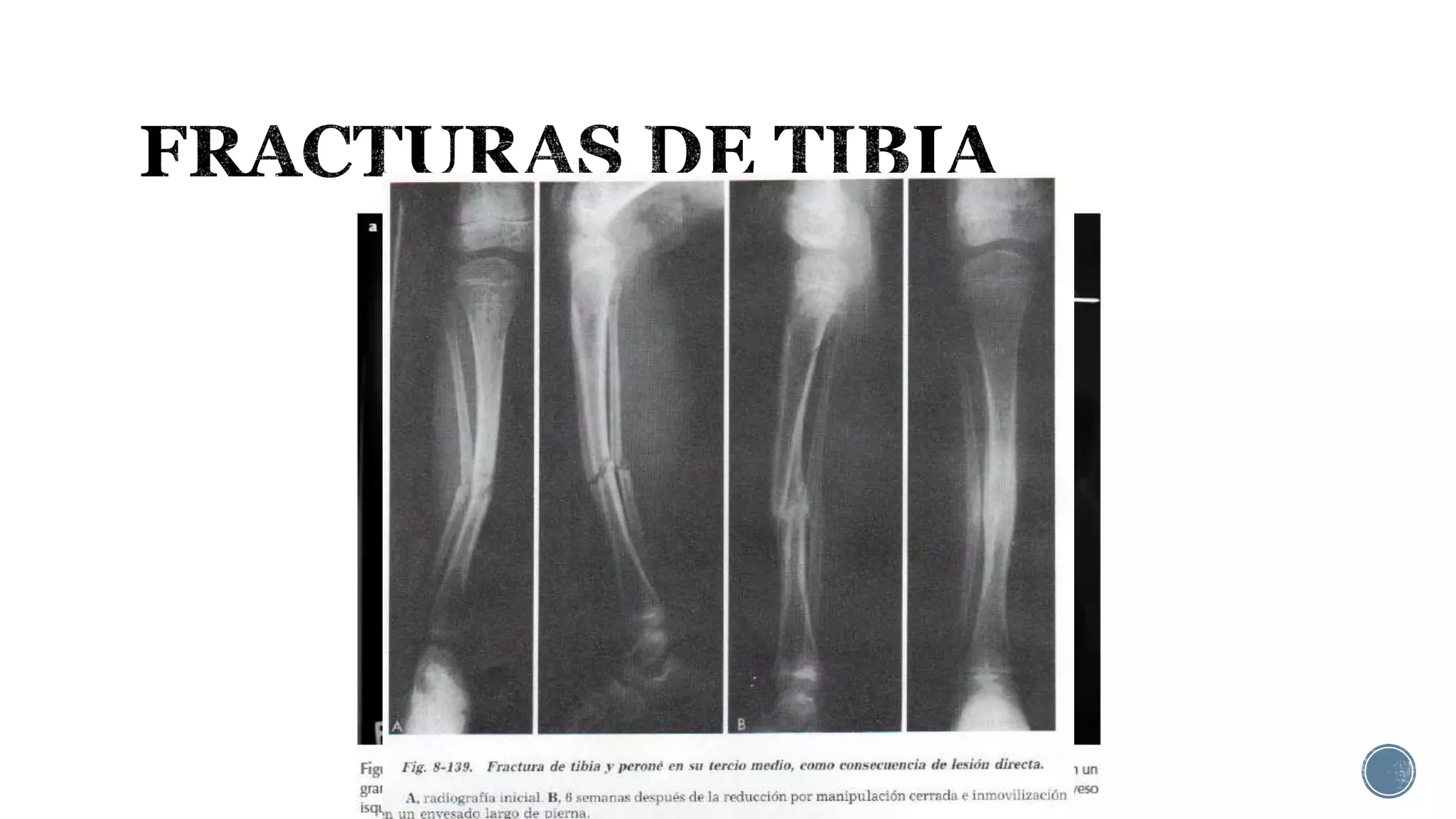 Fracturas de tibia y tobillo en niños | PPTX