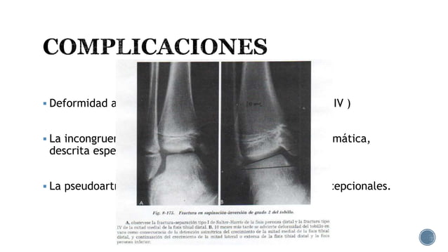 Fracturas de tibia y tobillo en niños | PPTX