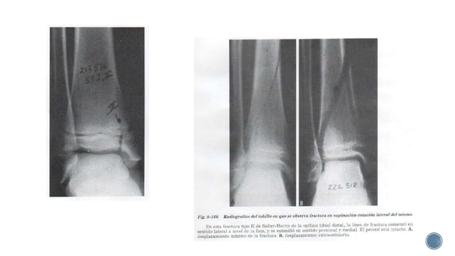 Fracturas de tibia y tobillo en niños