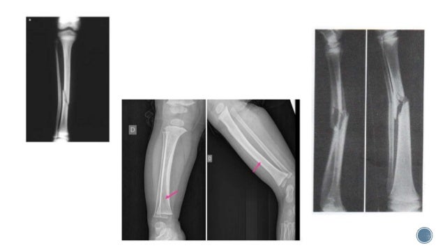 Fracturas de tibia y tobillo en niños