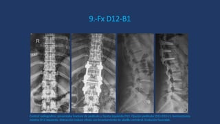 Fracturas Toracolumbares | PPTX