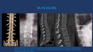 Fracturas Toracolumbares | PPTX