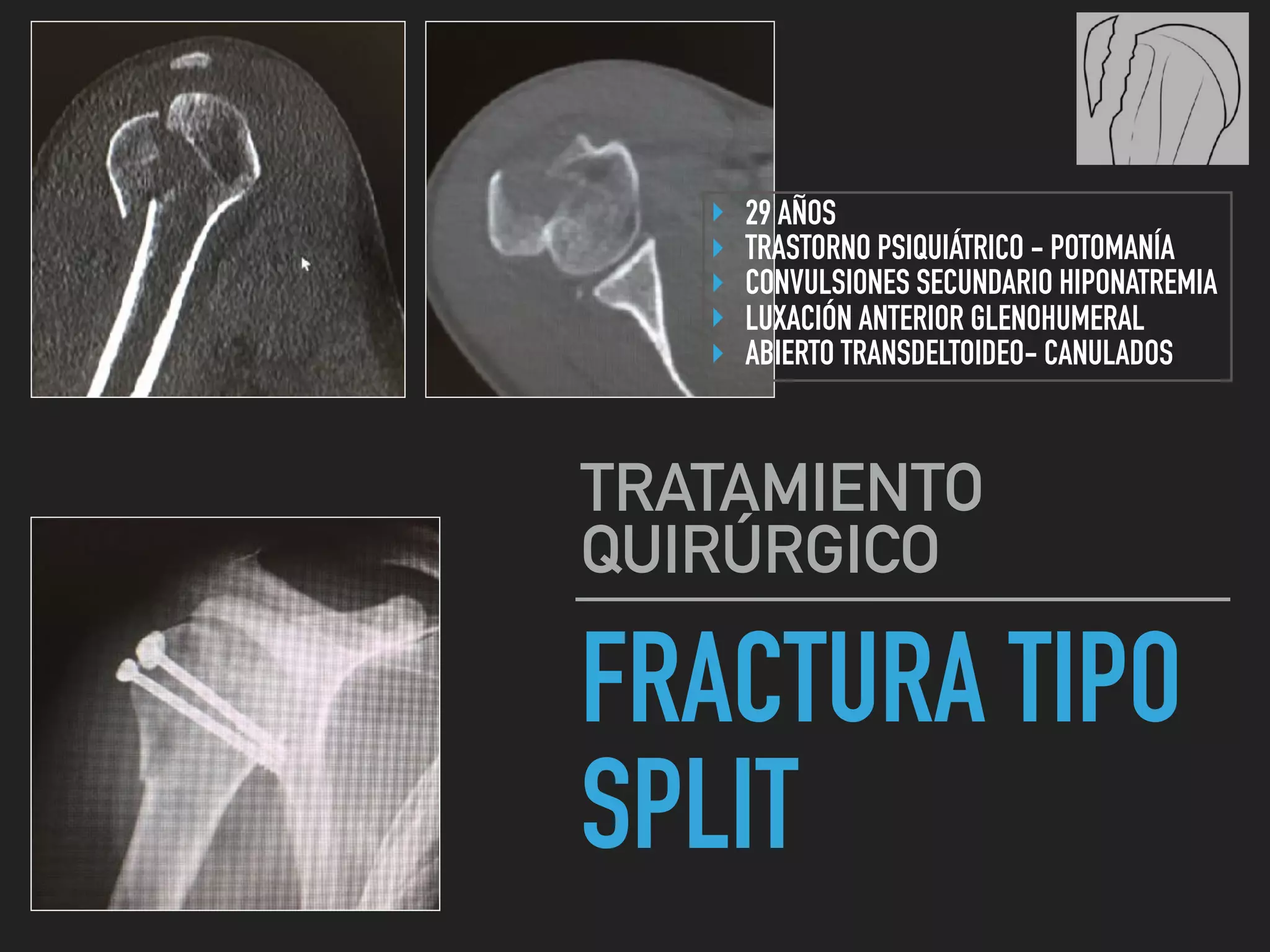 Fracturas troquiter hombro deportista | PDF