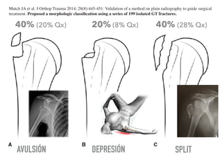 Fracturas troquiter hombro deportista | PDF