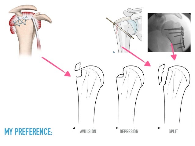 Fracturas troquiter hombro deportista