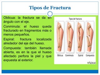 Fracturas Up Med Pptx