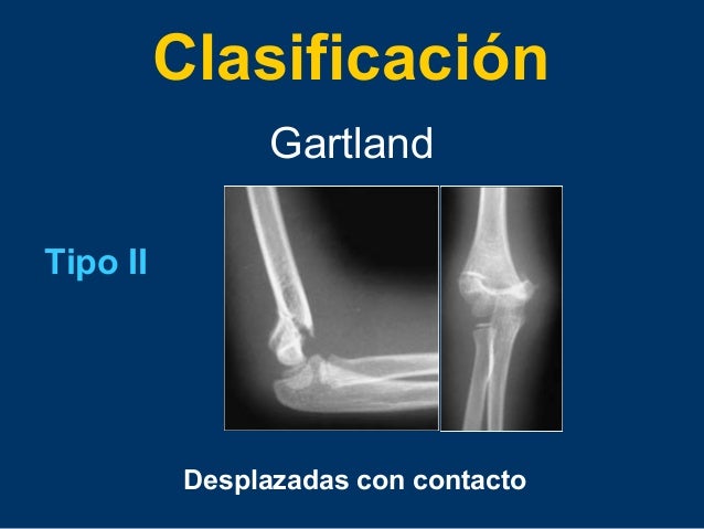 Fractura supracondileas en el niño
