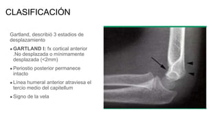 FRACTURA SUPRACONDÍLEA HÚMERO (3) - Copia.pptx