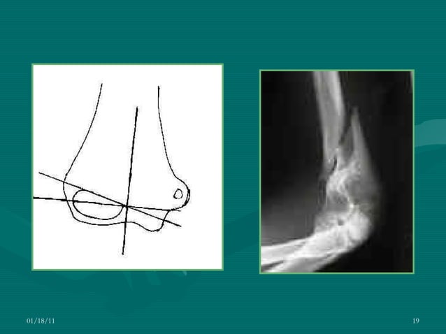 Fractura supracondílea, intercondílea humeral