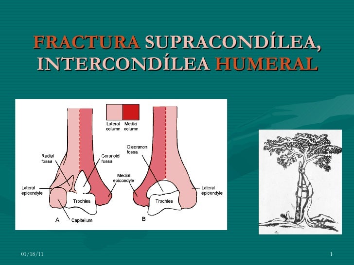 Fractura supracondílea, intercondílea humeral