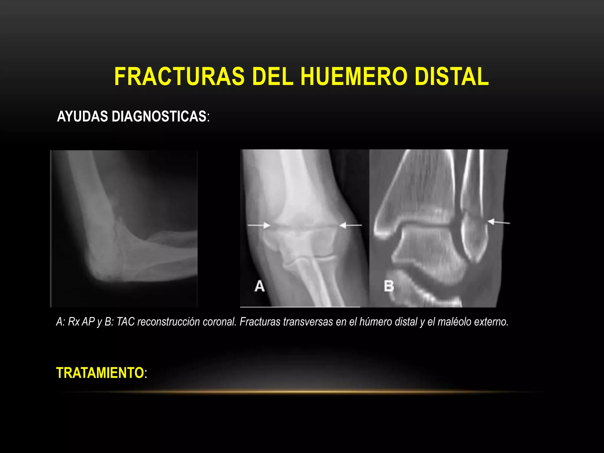 Fracturas y luxaciones del miembro superior | PPTX