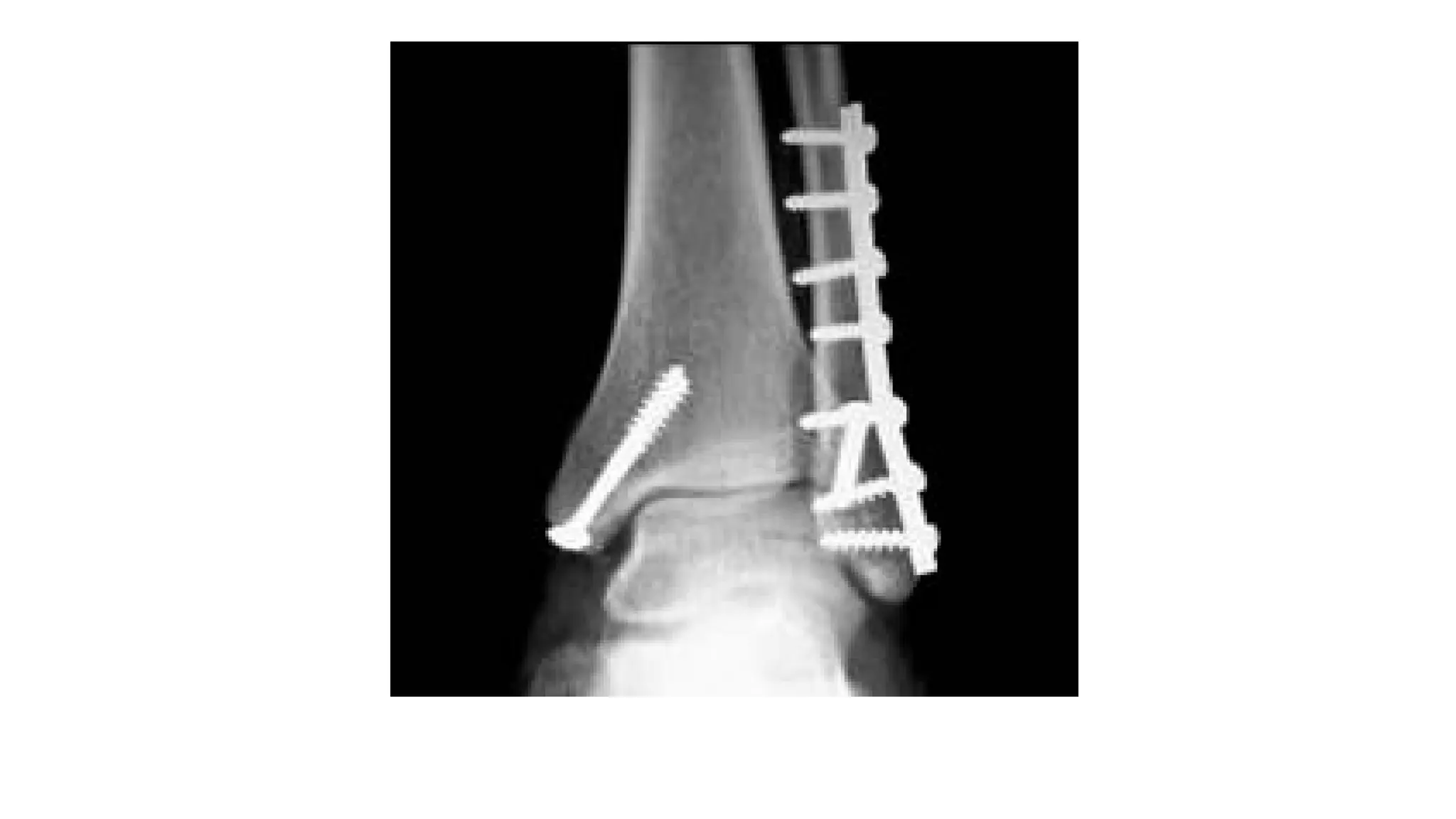 Fracturas expuestas de tibia y peroné, valoracion ortopedia | PPTX