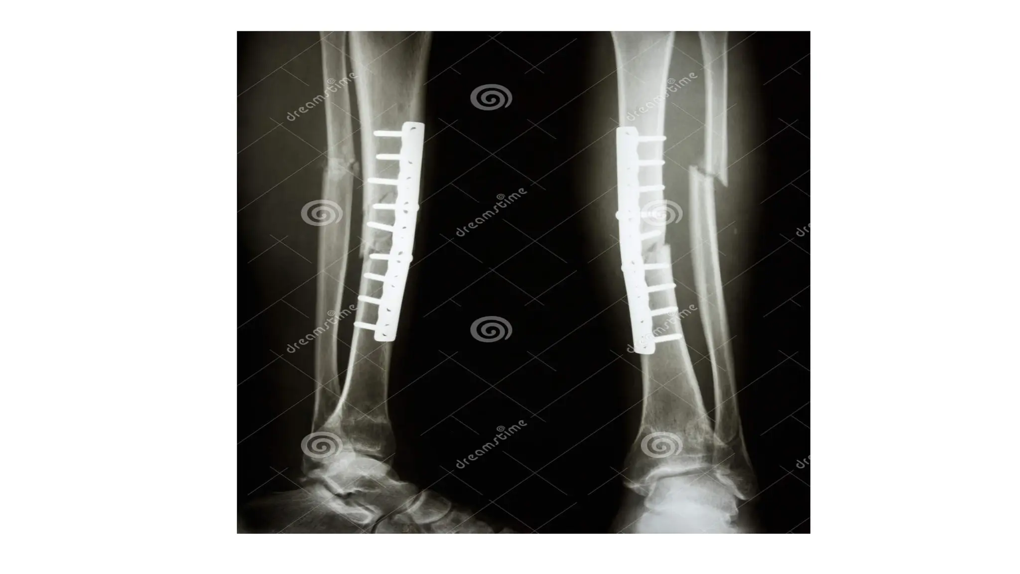 Fracturas expuestas de tibia y peroné, valoracion ortopedia | PPTX