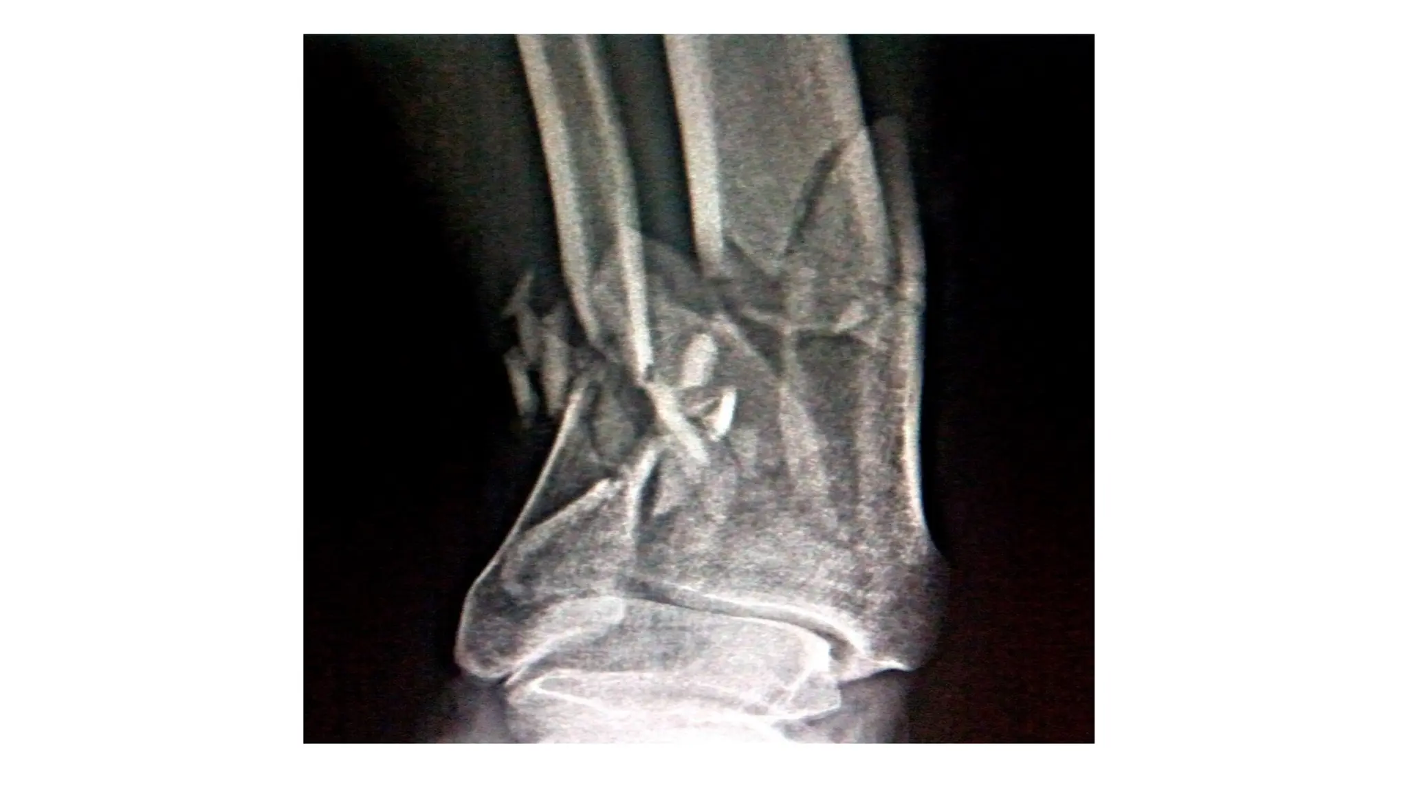 Fracturas expuestas de tibia y peroné, valoracion ortopedia | PPTX