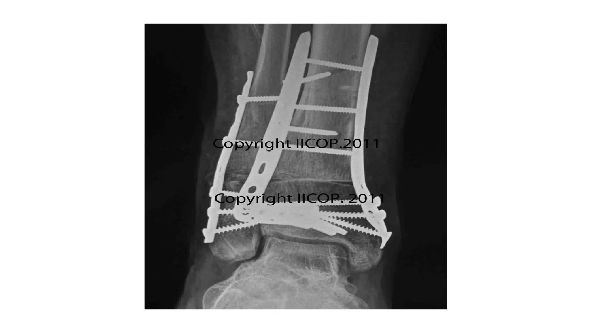 Fracturas expuestas de tibia y peroné, valoracion ortopedia | PPTX