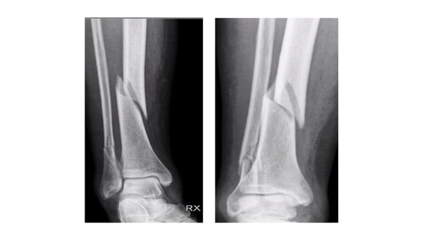 Fracturas expuestas de tibia y peroné, valoracion ortopedia | PPTX