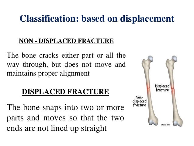 Open vs closed fracture - stserg