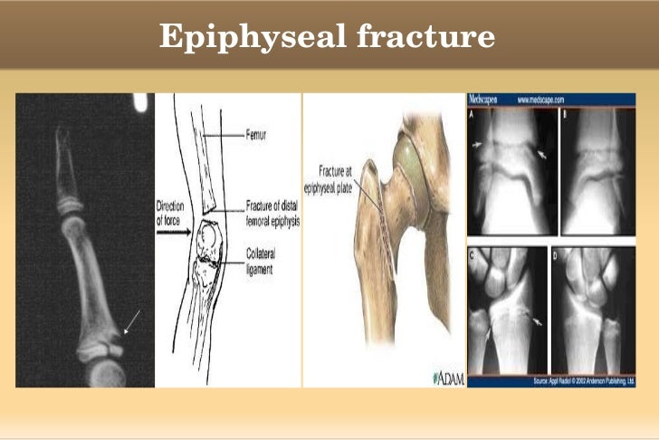 common types of fractures