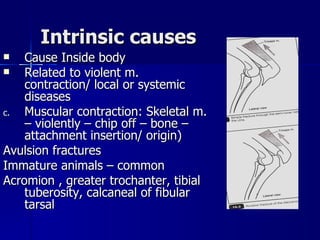 Types of fractures | PPT