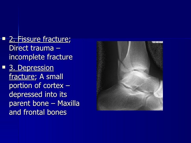 Types of fractures