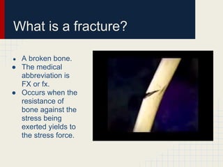 Fracture | PDF