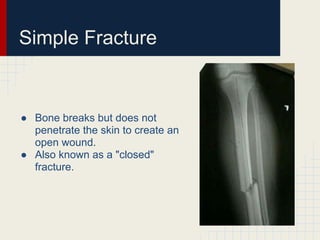Fracture | PDF