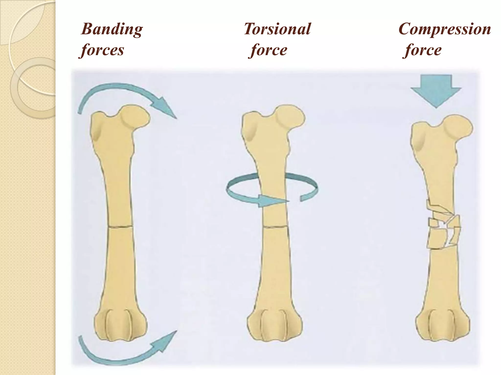 Fracture | PPTX