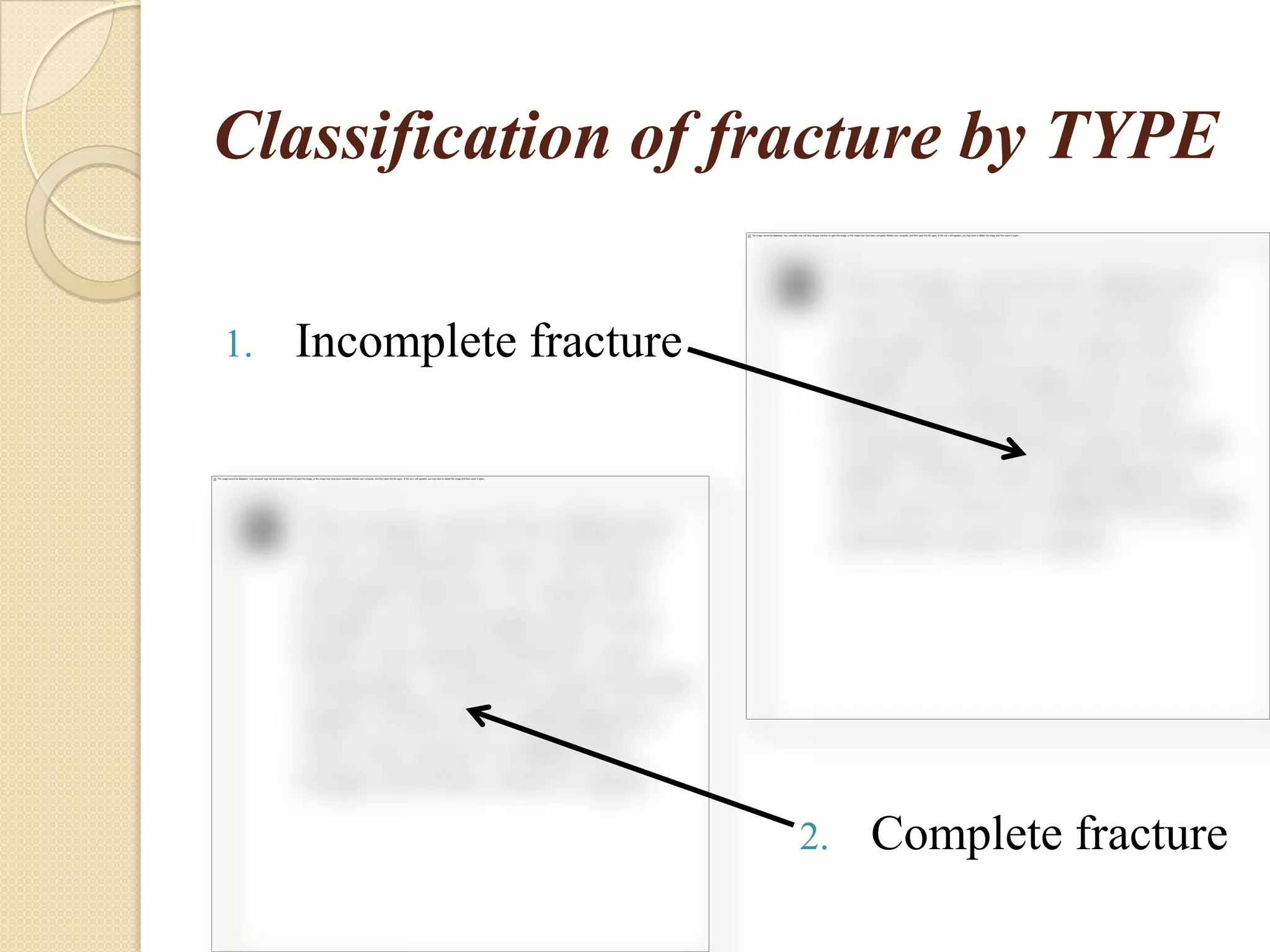 Fracture | PPTX
