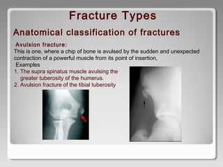 Fracture | PPT