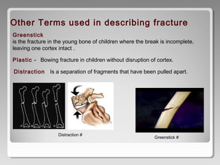 Fracture | PPT