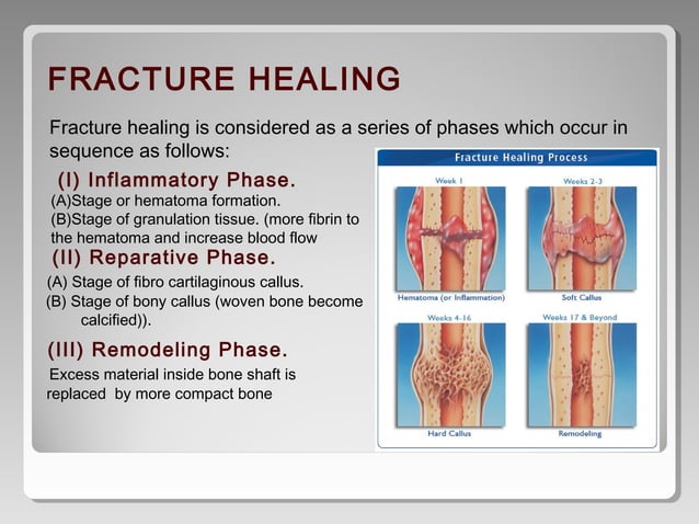 Fracture | PPT