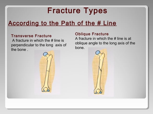 Fracture | PPT