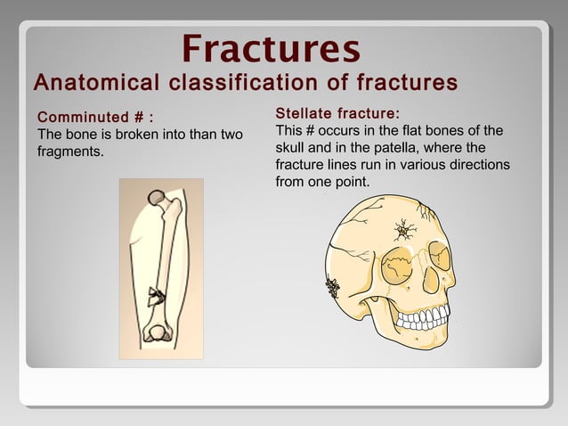 Fracture | PPT