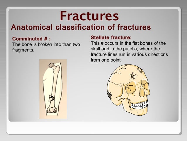 Fracture
