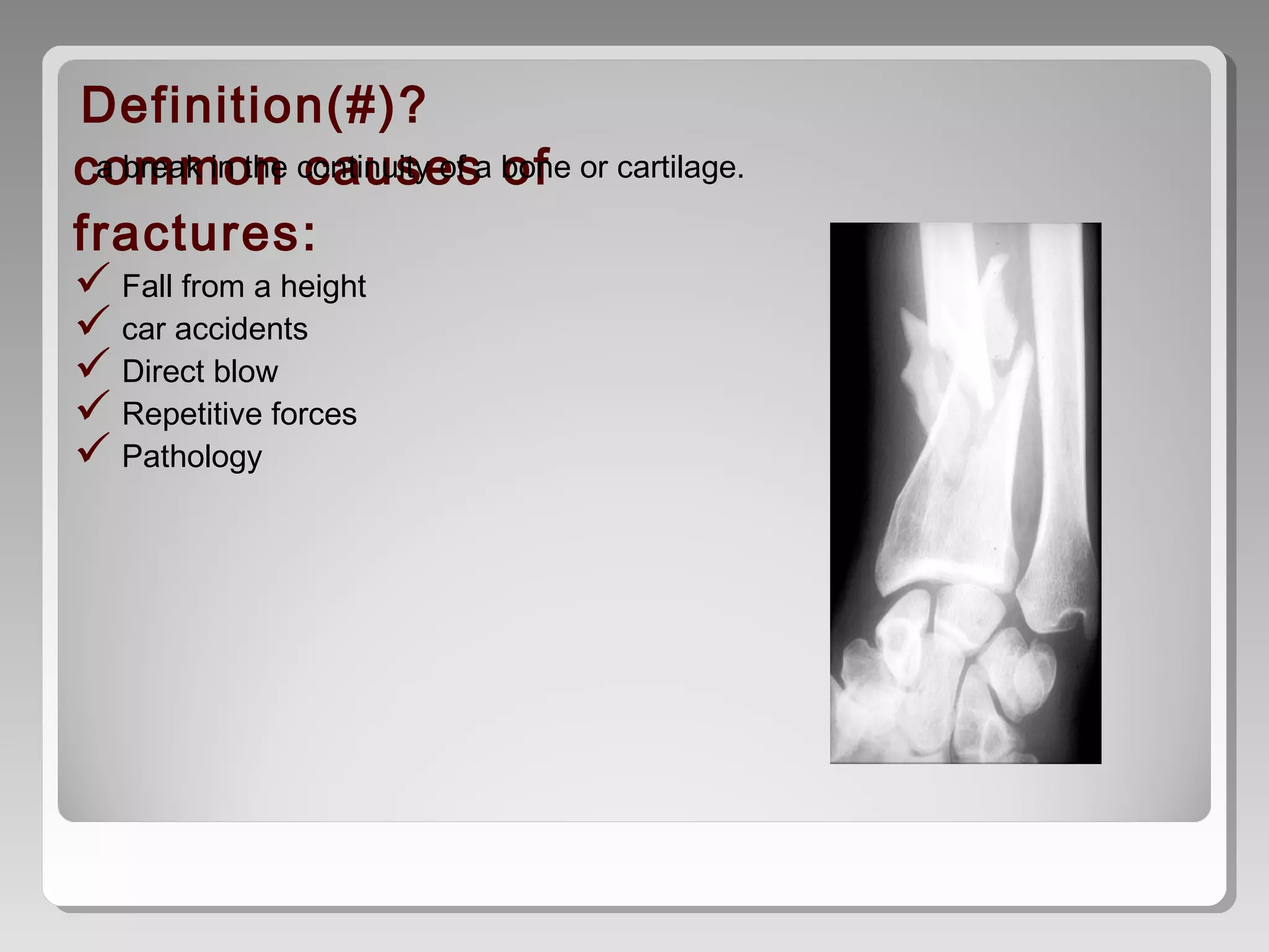Fracture | PPT