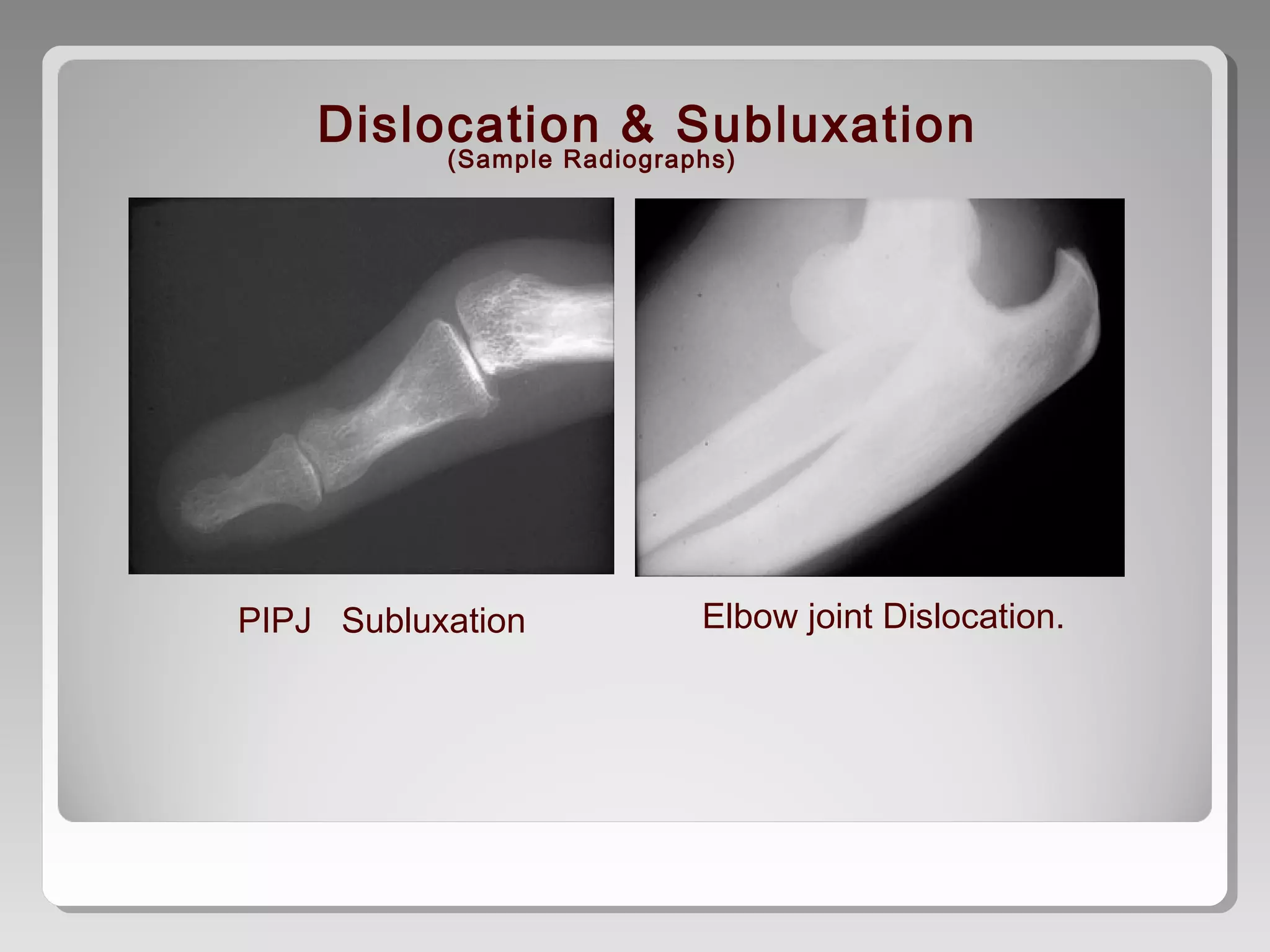 Fracture | PPT