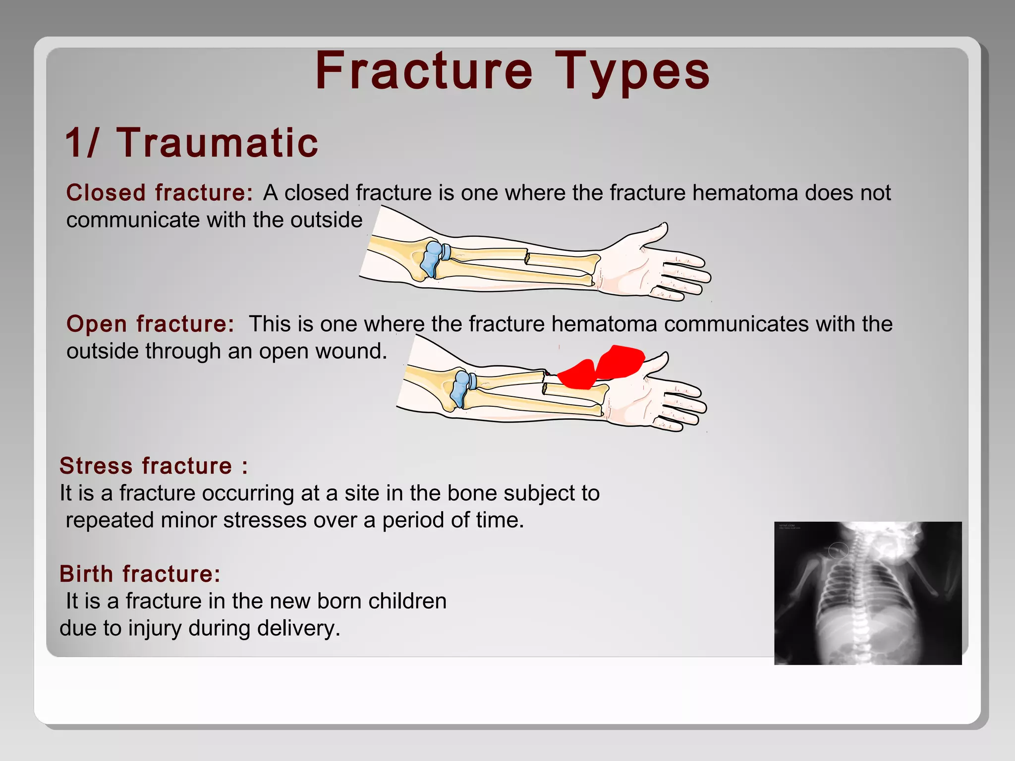 Fracture | PPT