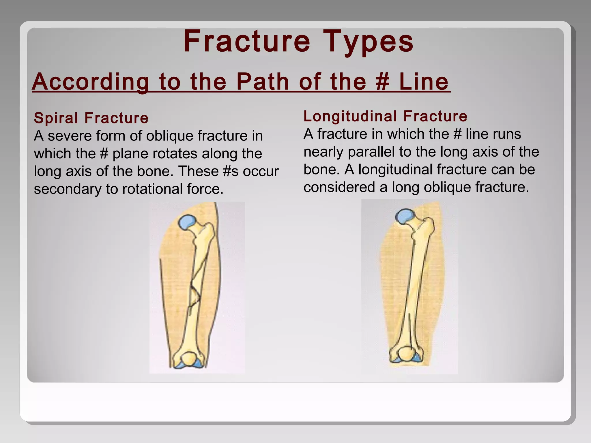 Fracture | PPT