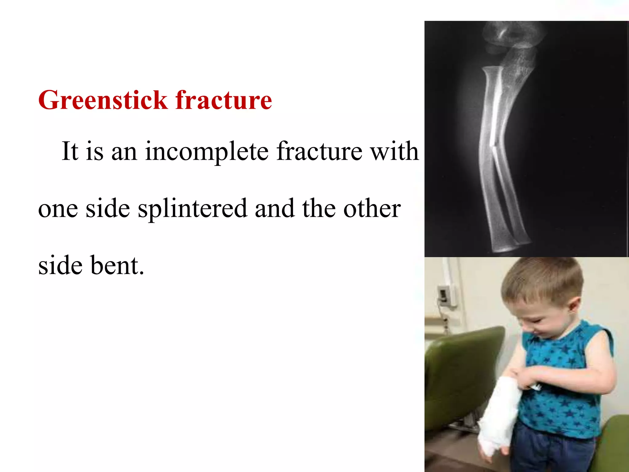 Fracture | PPTX