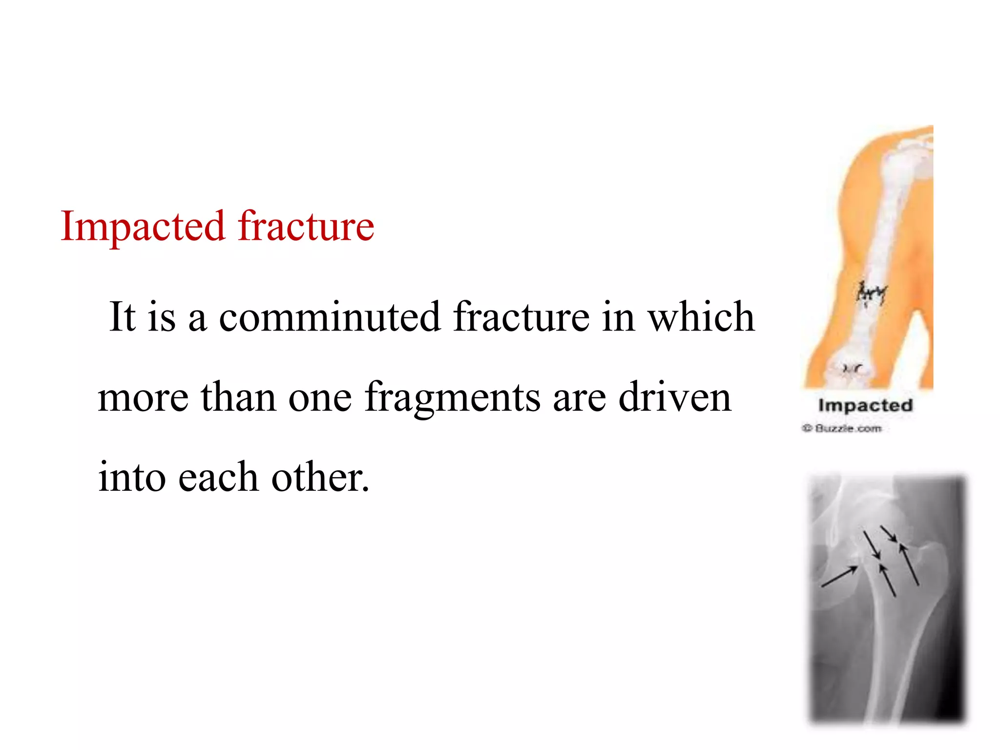 Fracture | PPTX