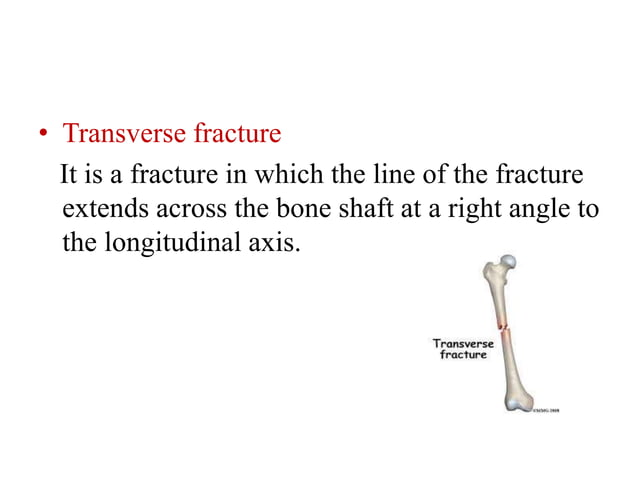 Fracture | PPTX