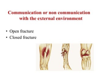 Fracture | PPTX