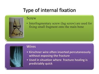 Fracture | PPTX