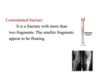 Fracture | PPTX