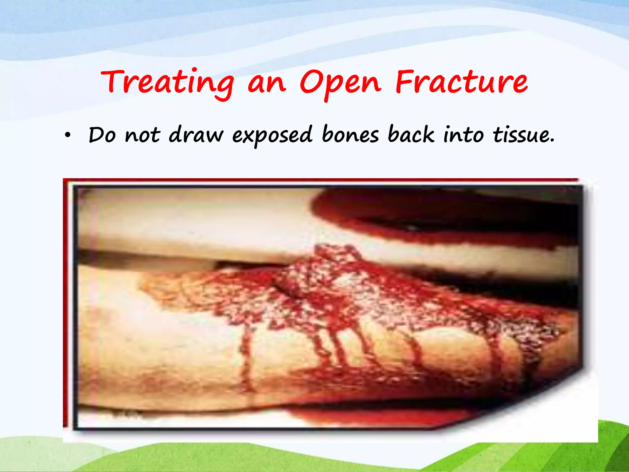 Fracture and its nursing management | PPTX