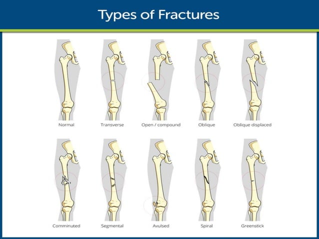 Fracture | PPT