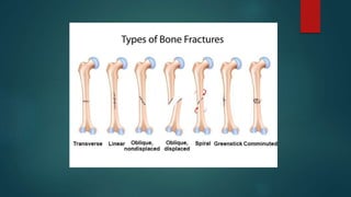 Fracture | PPT