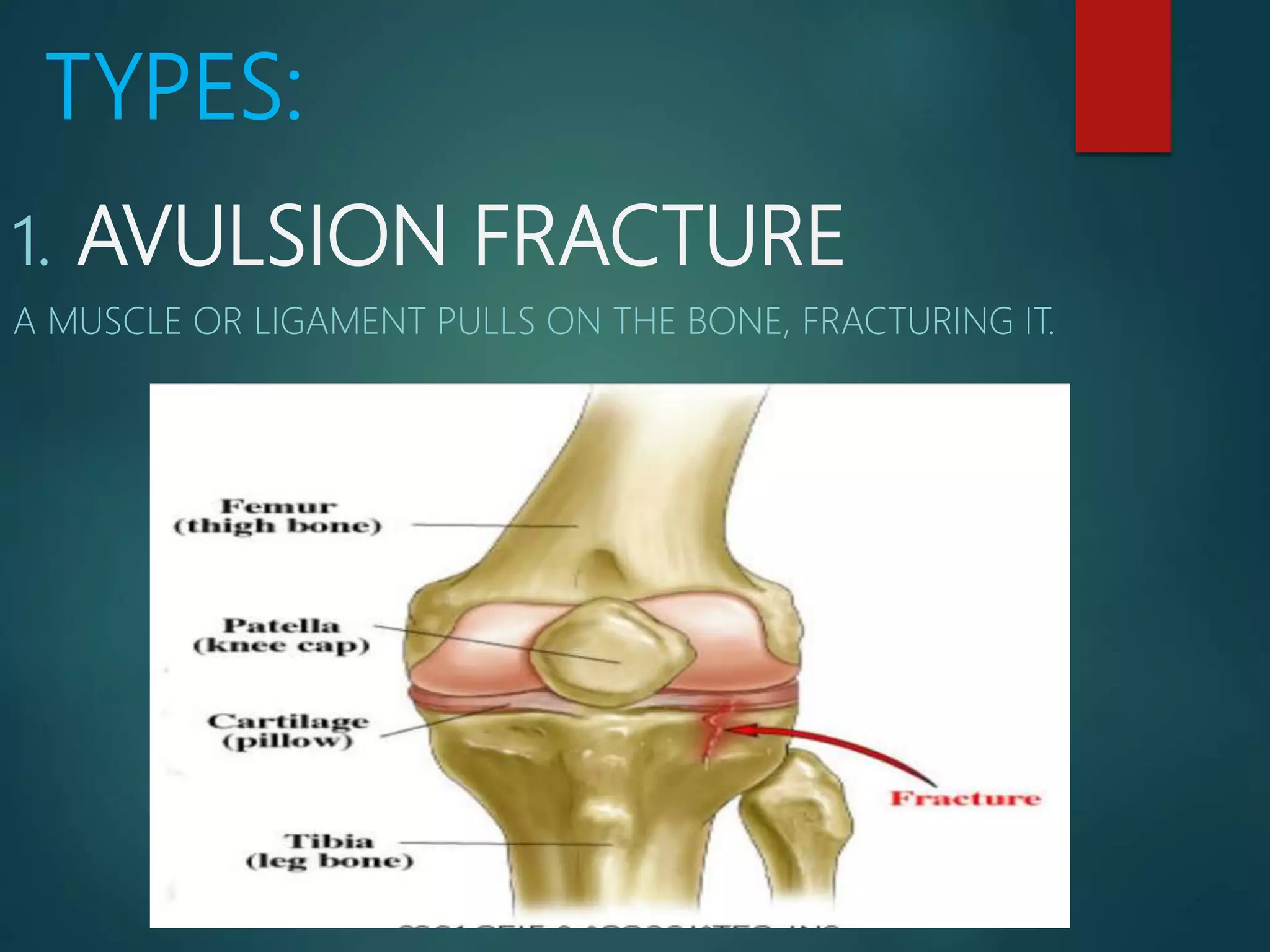 Fracture | PPTX
