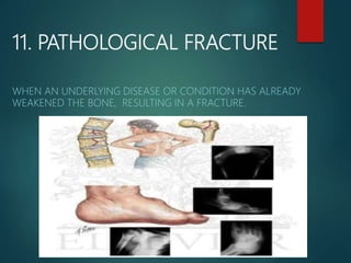 Fracture | PPTX